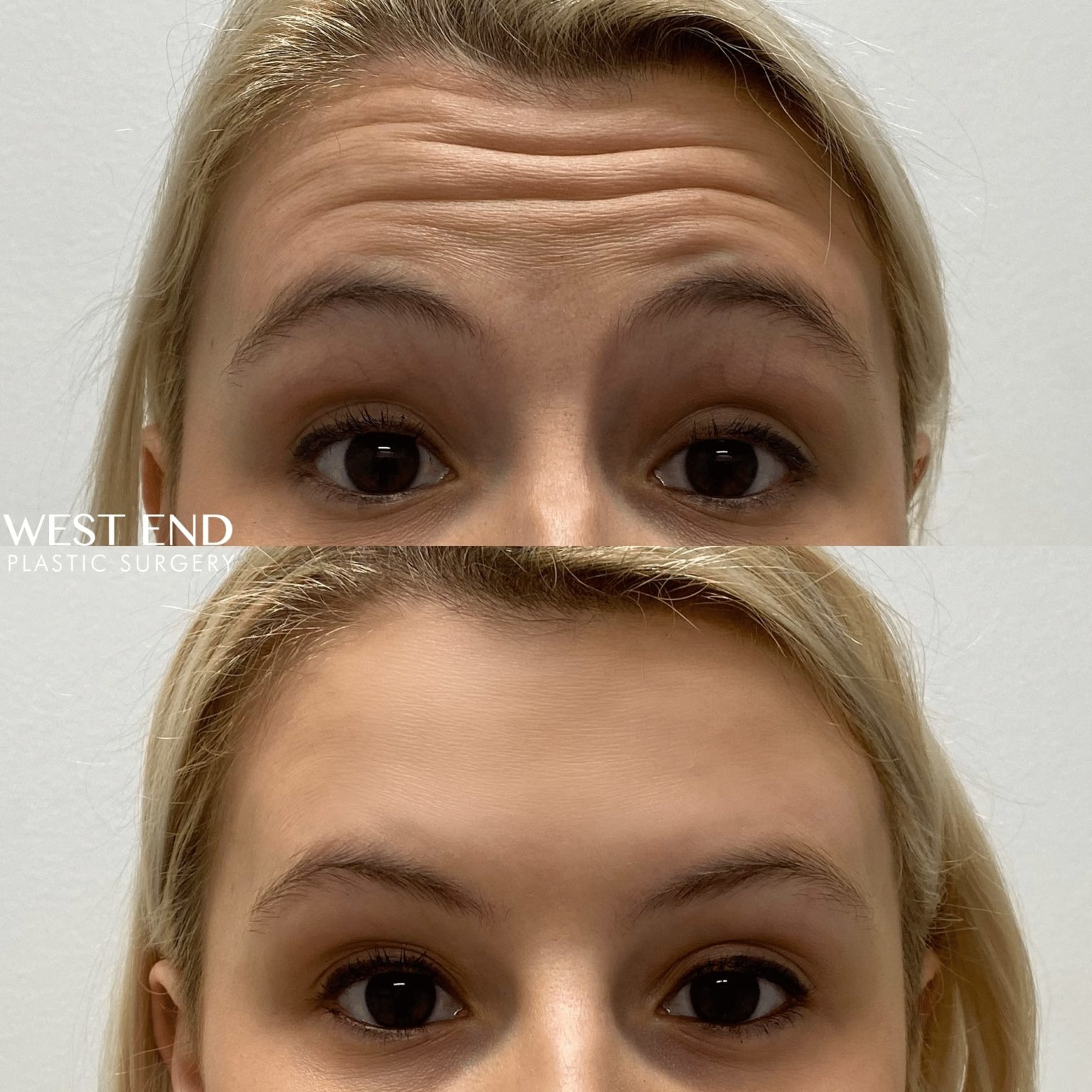 BOTOX Washington DC - BOTOX Injections Washington DC