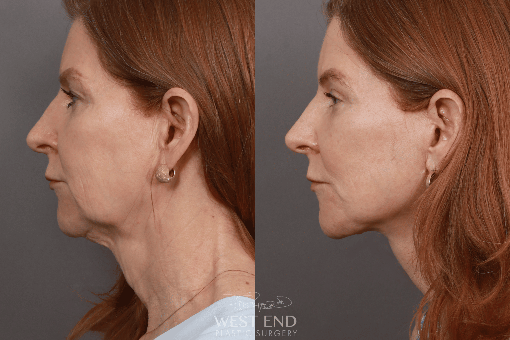 Facelift | What to Expect - West End Plastic Surgery Washington, DC