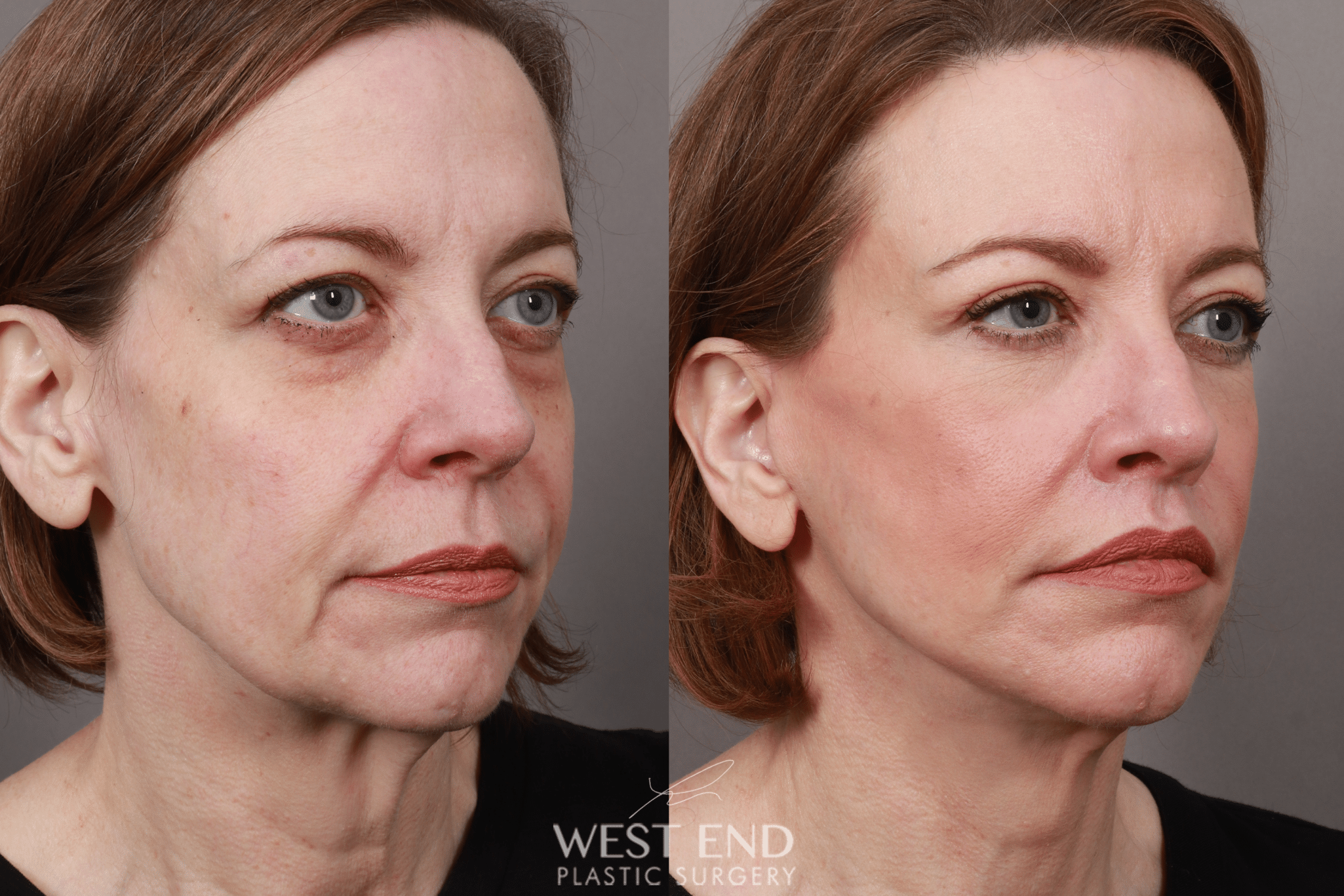 Facelift Surgery Washington DC - Top Facelift Surgeon