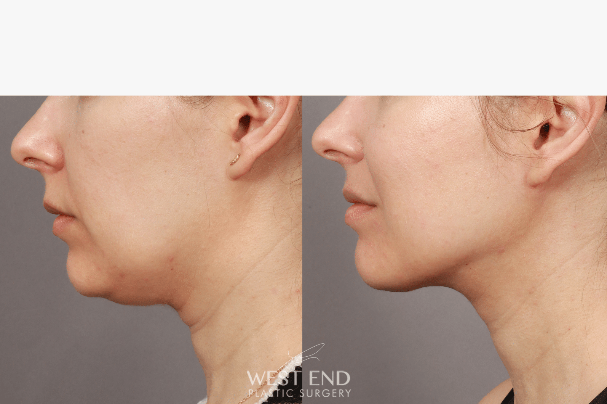 Neck & Chin Liposuction Washington DC - Facial Liposuction Surgeon