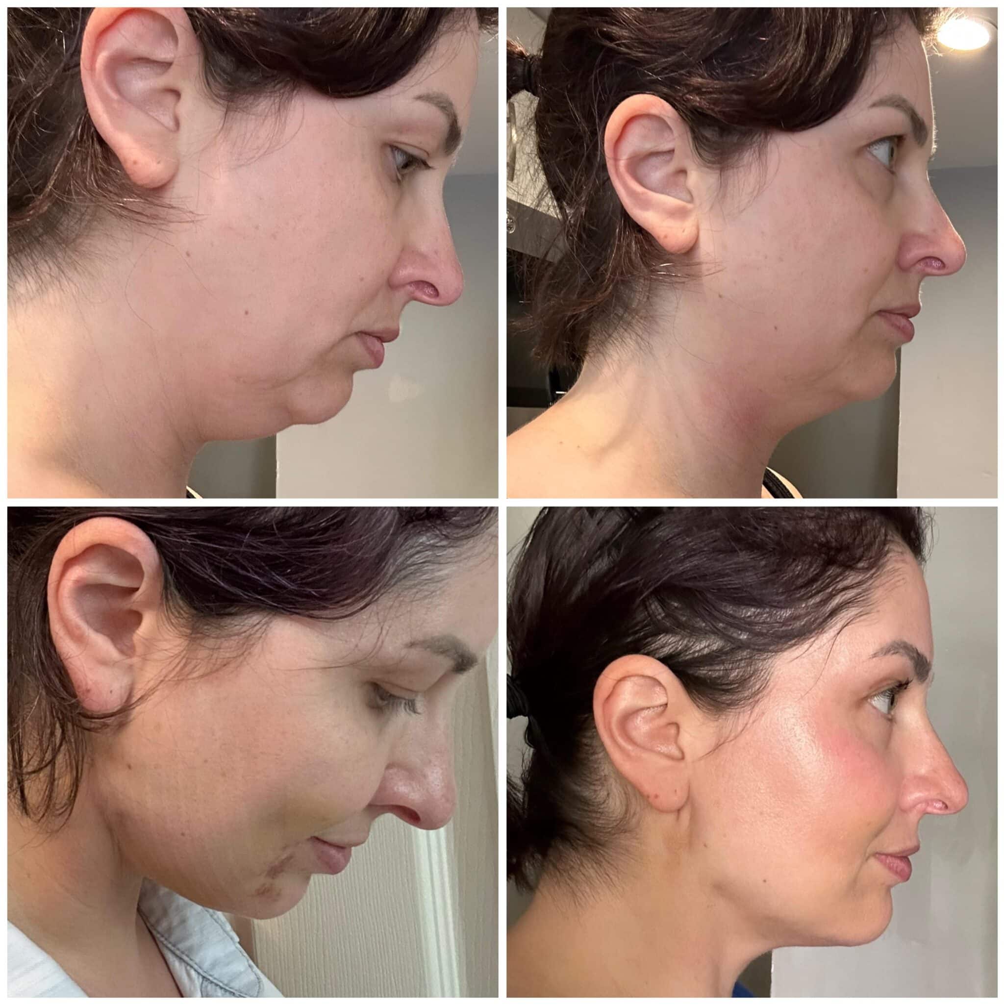 Neck & Chin Liposuction Washington DC - Facial Liposuction Surgeon