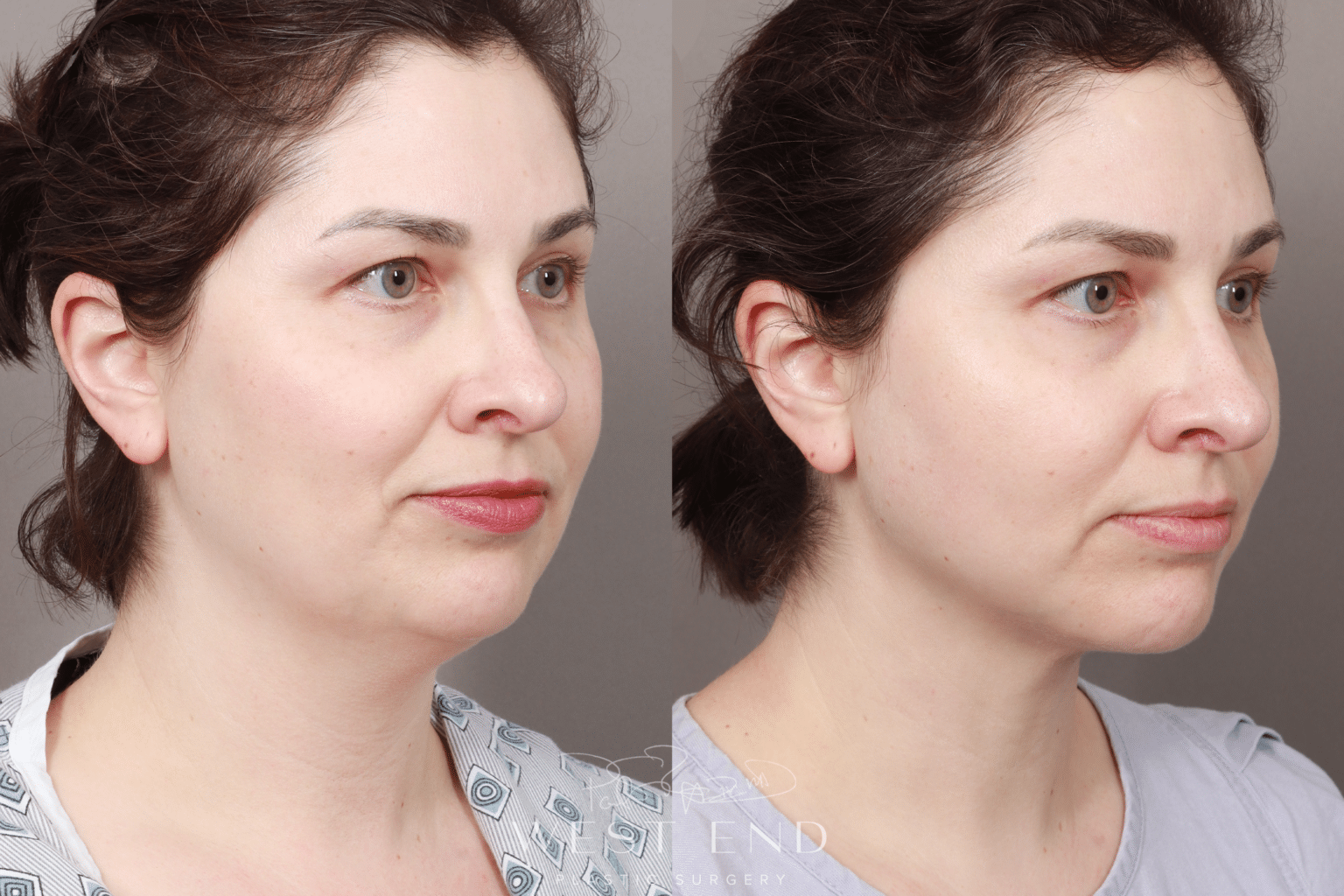 Renuvion Washington DC - Neck and Chin Skin Tightening