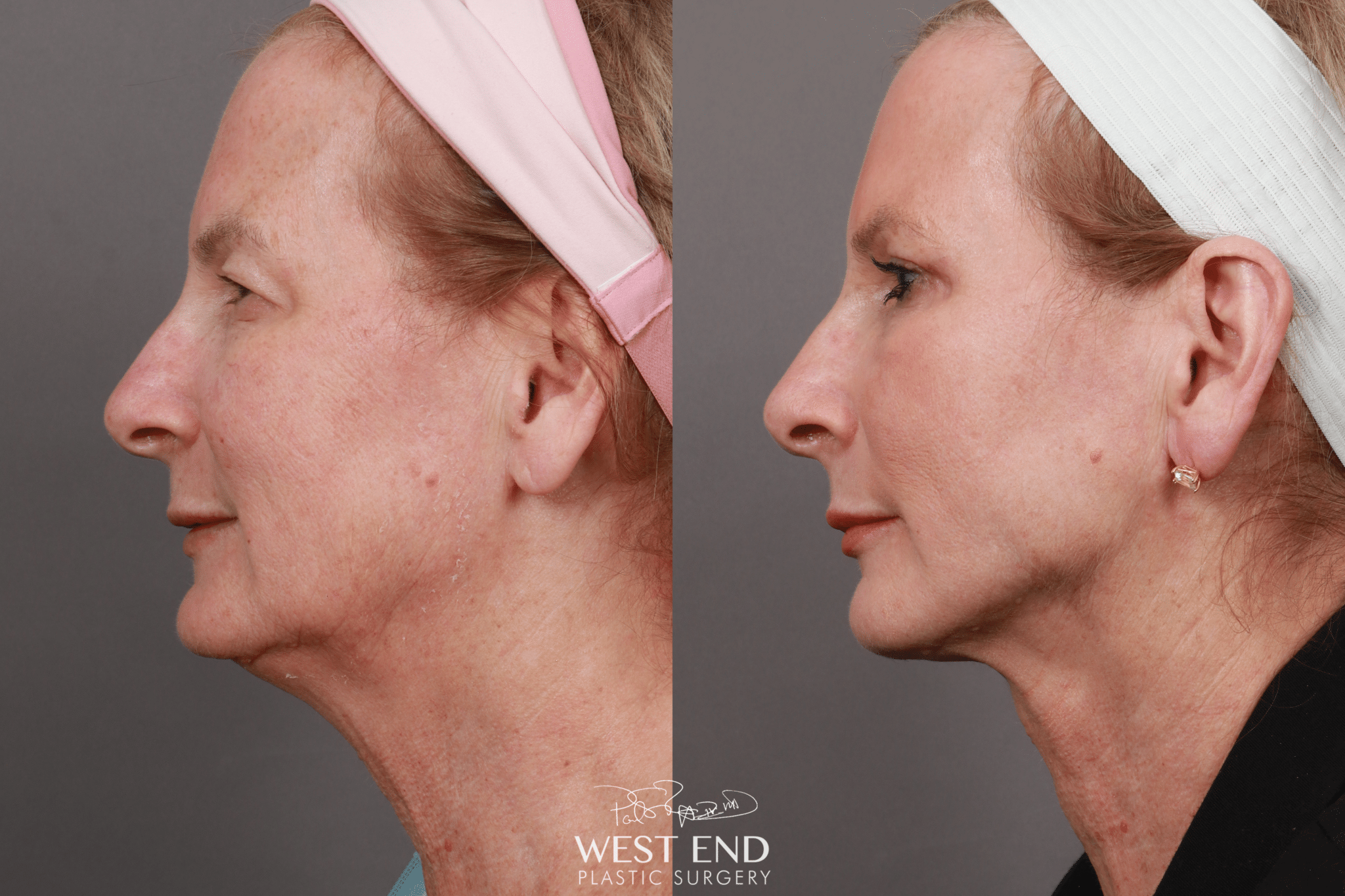 Renuvion Washington DC - Neck and Chin Skin Tightening